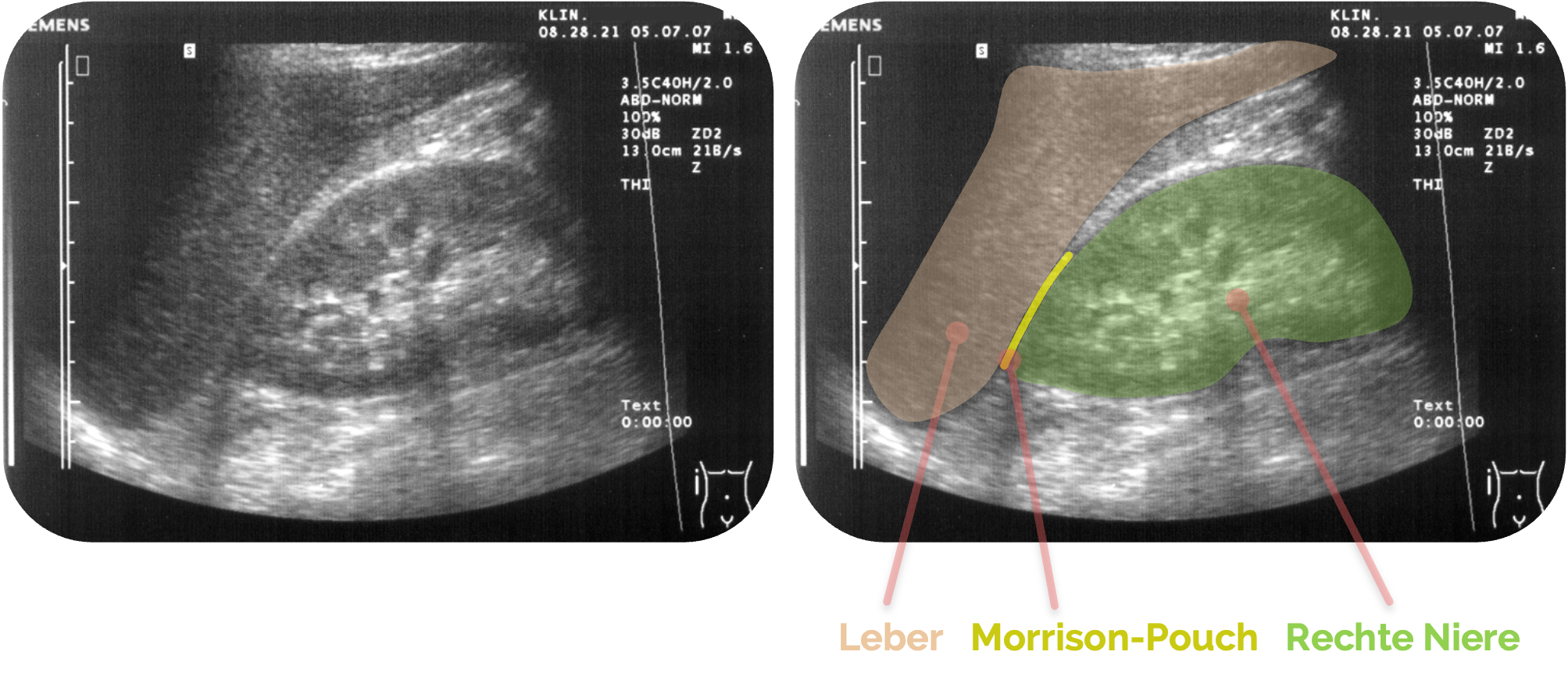 Notfallsonographie: Rechter Oberbauch/Morrison-Pouch - Medi Know